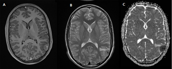 Giro Angular Del Cerebro